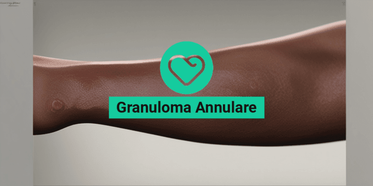 Granuloma Annulare: Causes, Symptoms, and Treatment Options • Yesil Health