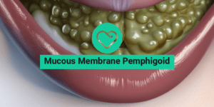 Mucous Membrane Pemphigoid: Causes, Symptoms, and Treatment Options ...