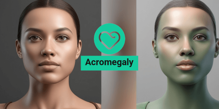 Acromegaly: Causes, Symptoms, Diagnosis, and Treatment Options • Yesil ...