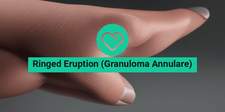 Ringed Eruption (Granuloma Annulare): Causes, Symptoms, and Treatment ...
