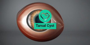 Tarsal Cyst: Causes, Symptoms, Diagnosis, and Treatment Options • Yesil ...