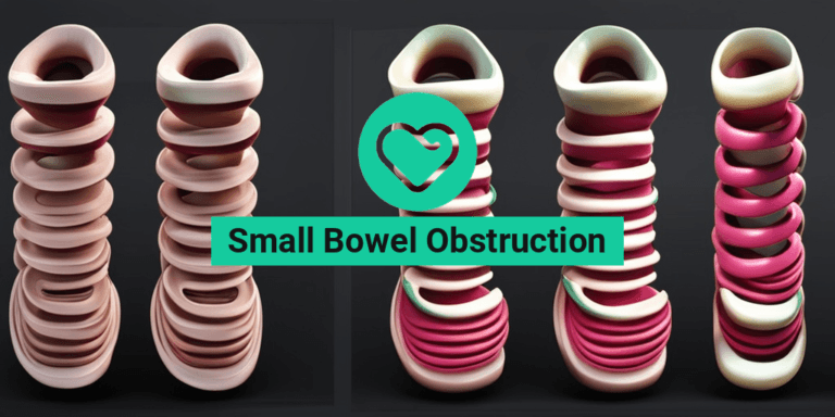 Small Bowel Obstruction: Causes, Symptoms, Diagnosis, and Treatment ...