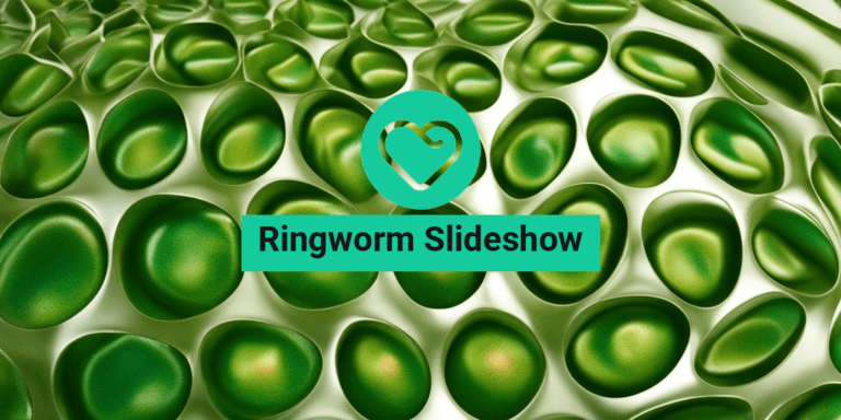 Ringworm Slideshow: Pictures, Symptoms, Causes, and Treatment • Yesil ...
